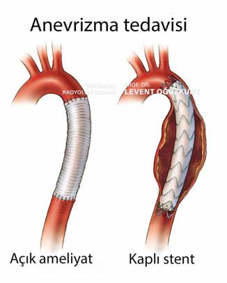 Torakal Aort Anevrizması | Prof. Dr. Levent OĞUZKURT